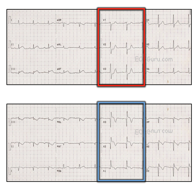 Inferior Wall M.I. With Subtle ST Elevation | ECG Guru - Instructor ... Inferior Wall M.I. With Subtle ST Elevation | ECG Guru - Instructor ...